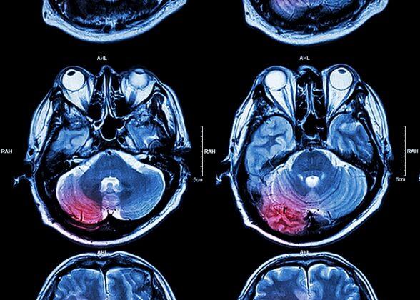 Emotional upset and heavy physical exertion as stroke triggers ...