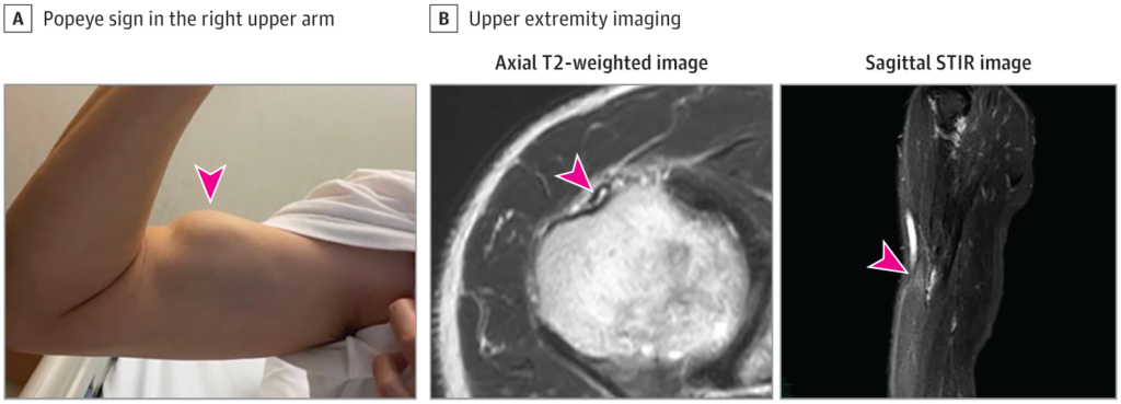 'Popeye' sign in hereditary transthyretin amyloidosis - Juta MedicalBrief