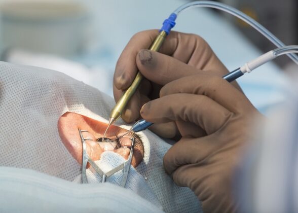 Canada’s first tooth-in-eye surgeries could restore blind man’s vision ...